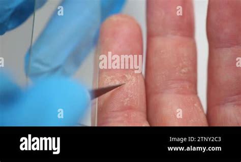 Laboratory Assistant Doctor Dermatologist Takes A Sample Of Patient