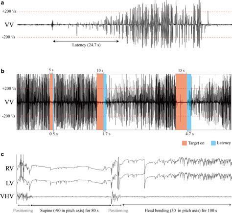 Effect Of Visual Fixation And Downbeat Nystagmus On Ocular Flutter The Download Scientific