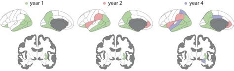 Regional Atrophy Progression In Pd Over Four Years Download