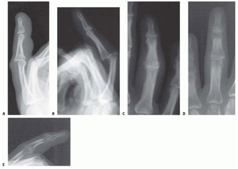 Dynamic External Fixation Of Proximal Interphalangeal Joint Fracture