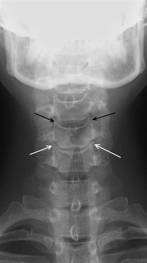 Female Abnormal Cervical Spine X Ray Vartap