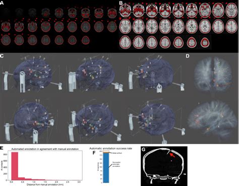 An Automated Algorithm For Stereoelectroencephalography Electrode