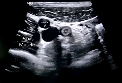 Daniel Ben Mordechay On Linkedin Ultrasound Acute Appendicitis