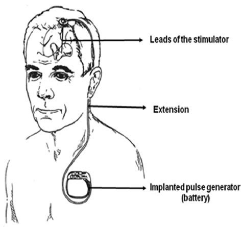 Figure 1 From Machine Learning Technique Based Closed Loop Deep Brain
