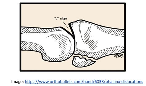 Em 3am Phalanx Dislocation Emdocs
