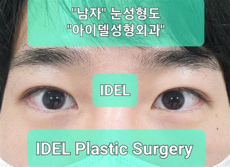 무쌍 And 속쌍 남자눈성형도 아이델성형외과 수술 후 경과 동영상 노보정 기본카메라 눈성형은아이델 눈성형맛집 쌍수맛집