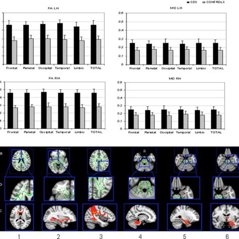 Diffusion Tensor Imaging Dti And Tract Based Spatial Statistics