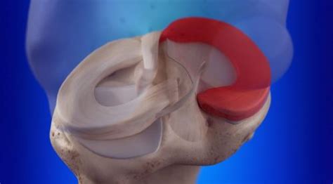 Ruptură De Menisc Ce Ar Trebui Să știți Angisan