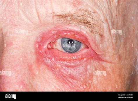 Blepharoconjunctivitis Close Up Of The Eye Of An 89 Year Old Male Patient With Inflammation Of