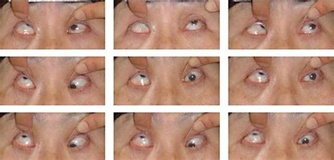 Figure 1 From Modified Muscle Transposition Procedure For A Case Of Inferior Rectus Muscle