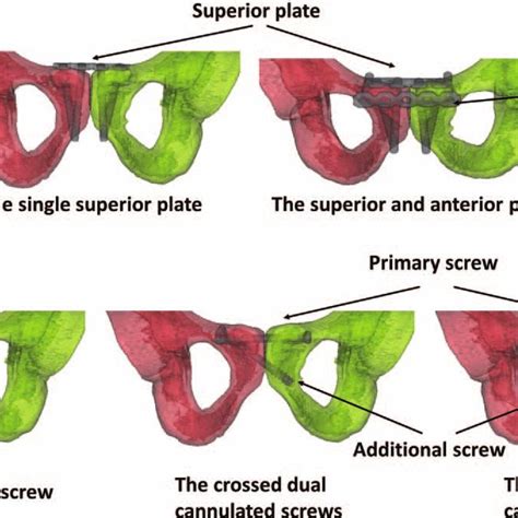 The Incremental Rotational Angle Of The Posterior Pelvic Ring Mm Download Table