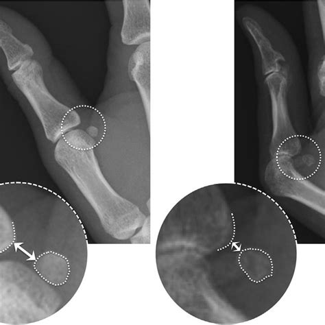 Schema Of Type I Thumb Deformity As A Result Of Arthritis Of The Mcp