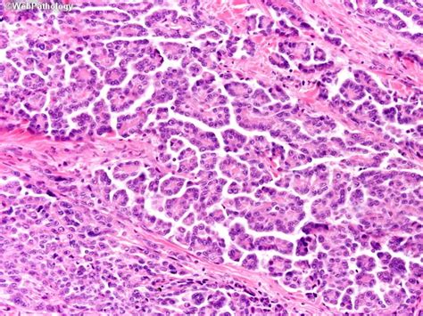 Malignant Mesothelioma Epithelioid