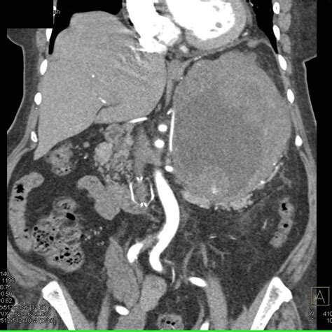 Ulcerating Gastric Gist Tumor Stomach Case Studies Ctisus Ct