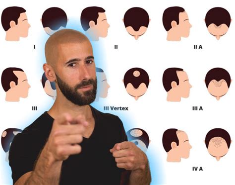 Norwood Patterns Is It Possible To Have A Successful Hair Transplant