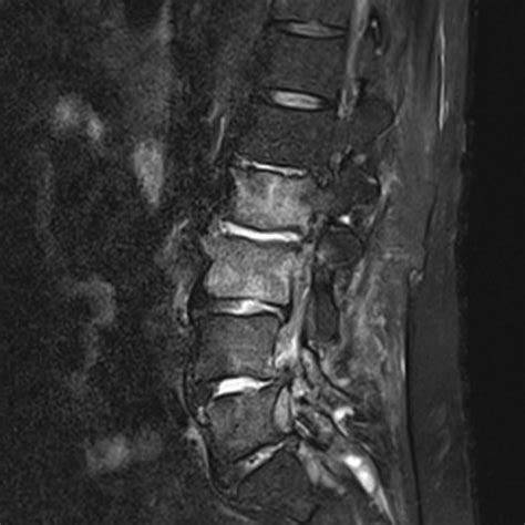 Regarding A Case Of Pyogenic Spondylodiscitis Eurorad
