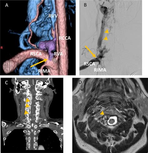 Arteriovenous Fistula And Resultant Epidural Venous Dilatation In
