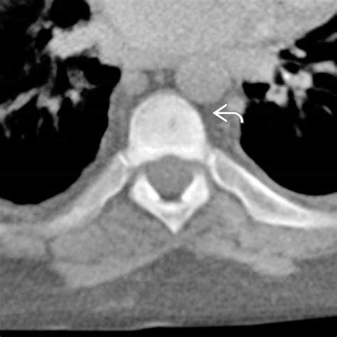 Renal Osteodystrophy Radiology Key