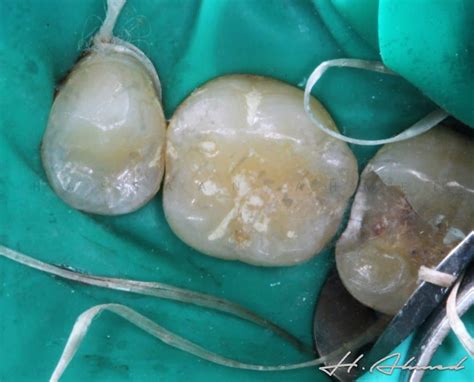 Class Ii Composite Restoration First Experience Myzerodonto