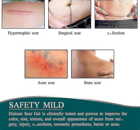 Silicone Plasters For Scars Silicone Scar Films For Surgeries