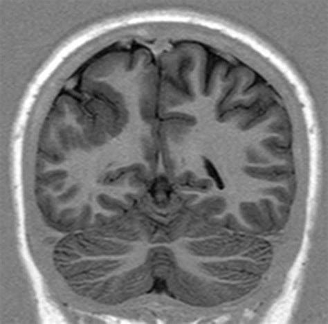 Polymicrogyria Neuro Mr Radiology Case Studies Ctisus Ct Scanning