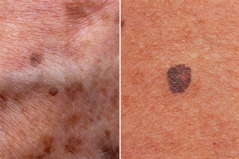 Melanoma Light Brown Spots On Skin Infoupdate Org