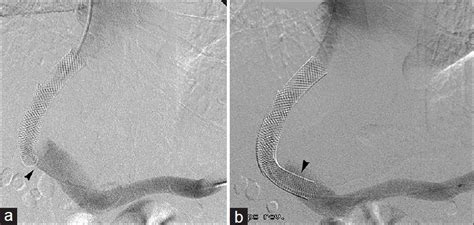 Angiographic Patterns Of Transjugular Intrahepatic Portosystemic Shunt Dysfunction And