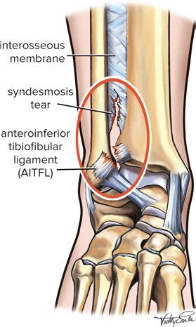 High Ankle Sprain