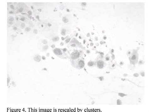 Figure 4 From Automatic Segmentation Of Abnormal Cell Nuclei From Microscopic Image Analysis For