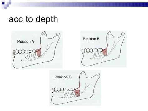 Impaction