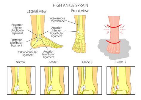 Severe Sprained Ankle Recovery Time Jjphoe