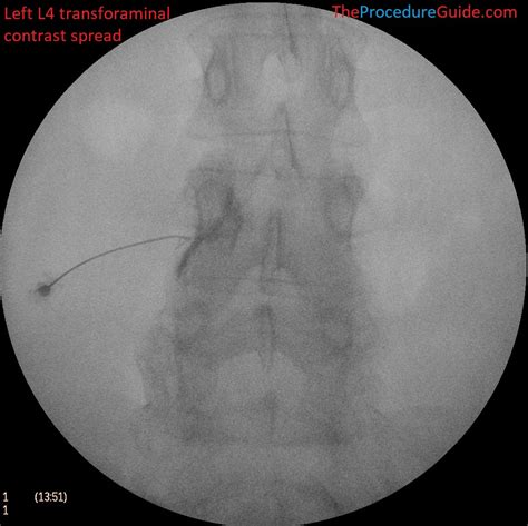 Fluoroscopic Guided Shoulder Subacromial Bursa Sab Injection Technique And Overview The