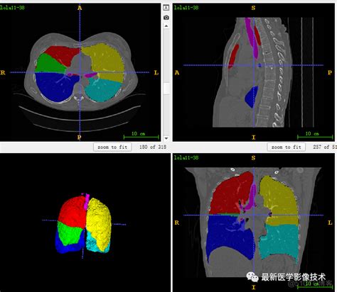 Lola11——肺叶和肺分割挑战赛201112697048的技术博客51cto博客