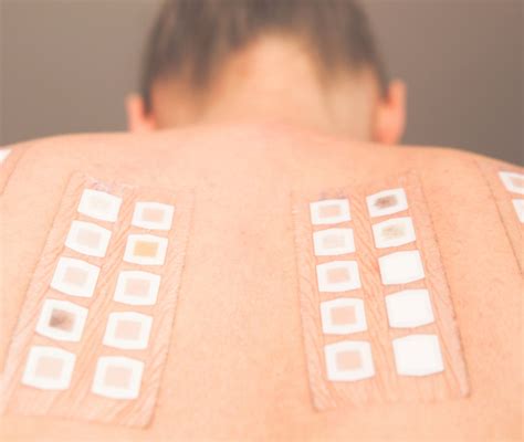 Patch Test Allergie