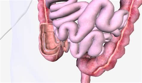 Intussusception Is The Sliding Of One Part Of The Intestine Into Stock Intussusception Is The Sliding Of One Part Of The Intestine Into Stock