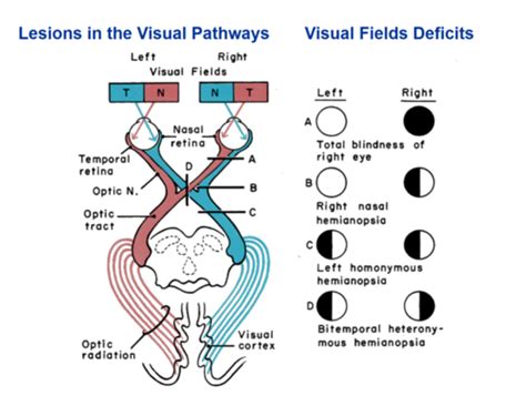 Optic Nerve Lesions Flashcards Quizlet