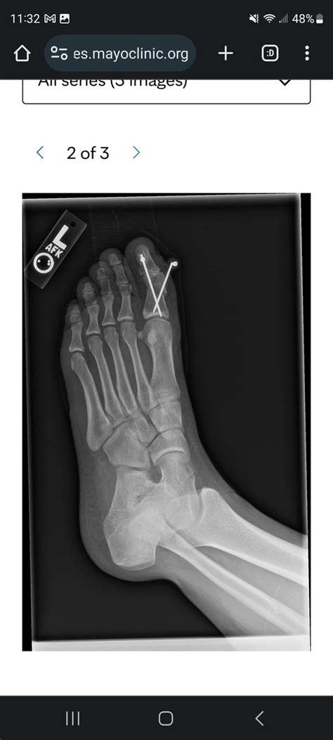 Broken Great Toe Rbrokenbones