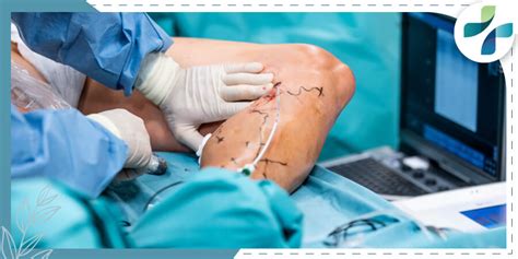 Cirugía De Várices Dr César Andrés Mafla Cirujano Vascular Ibarra