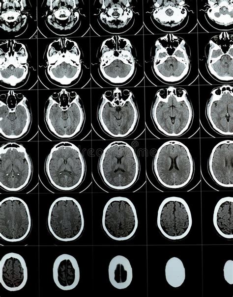 Multi Slice Ct Scan Of The Brain Showing Large Brain Stem And Right