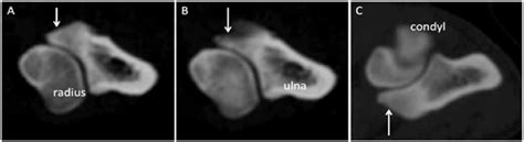 Transverse Ct Images In Bone Algorithm At The Level Of The Medial
