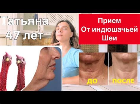 Индюшачья шея, второй подбородок - убираем. За комплексной работой ...