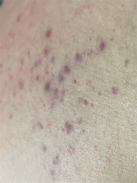 이거 두드러기 인가요ㅠㅠㅠ 지식in