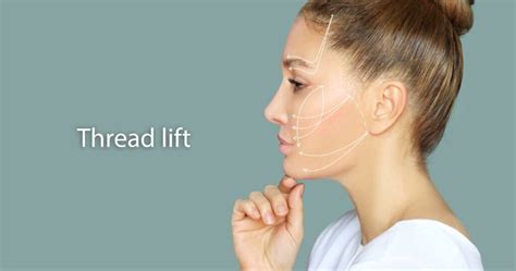 12 faqs about thread lift