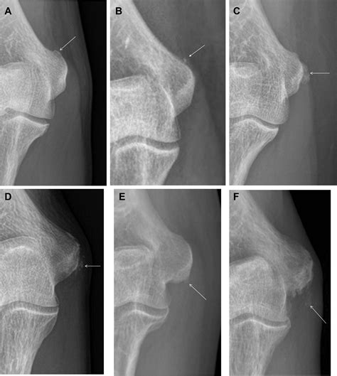 Medial Epicondylitis Elbow X Ray