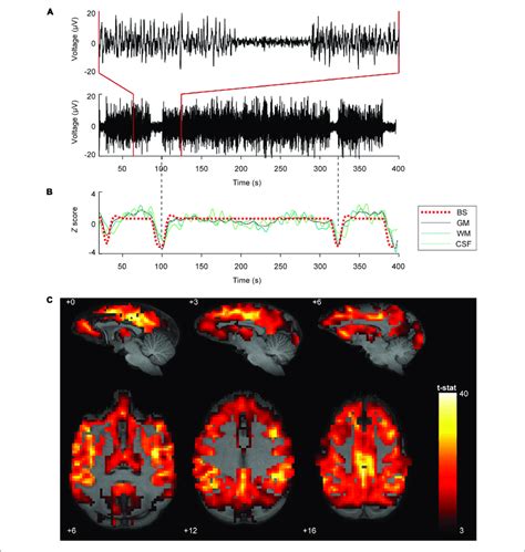 coupling between bold fluctuations and burst suppression patterns in