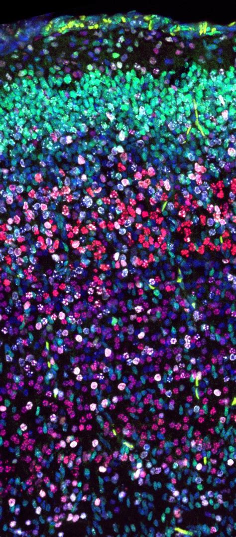 Defective Gene Slows Down Brain Cells High Risk Gene For Developing Autism