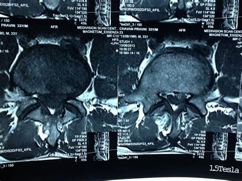 Indian Spine Group 33 Year Old Male Patient Having Pain In Right Leg