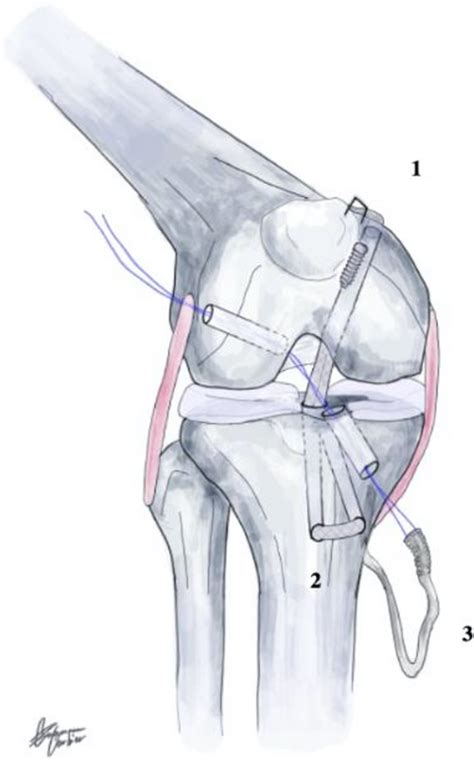 Illustration Of The Surgical Technique 1—lars Femoral Fixation Of The