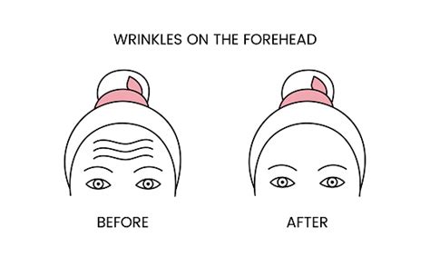 이마의 주름 시술 전과 벡터에 치료 라인 아이콘을 적용한 후의 레이저 미용 매끄럽고 깨끗한 피부와 문제성 피부를 가진 여성의 삽화 건강관리와 의술에 대한 스톡 벡터 아트 및