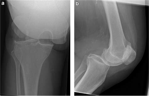 Case 3 Posterior Dislocation A Anteroposterior View B Lateral